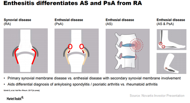 How Cosentyx Resolves Enthesitis in Psoriatic Arthritis Patients