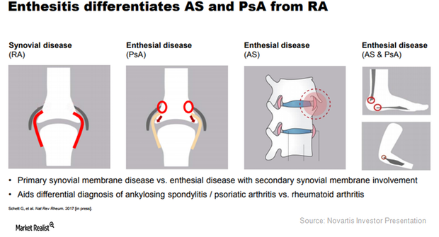 How Cosentyx Resolves Enthesitis in Psoriatic Arthritis Patients
